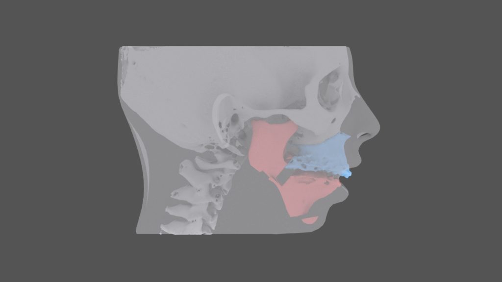 Learning Jaw Surgery with Virtual Reality ⋆ X-Reality: University of ...