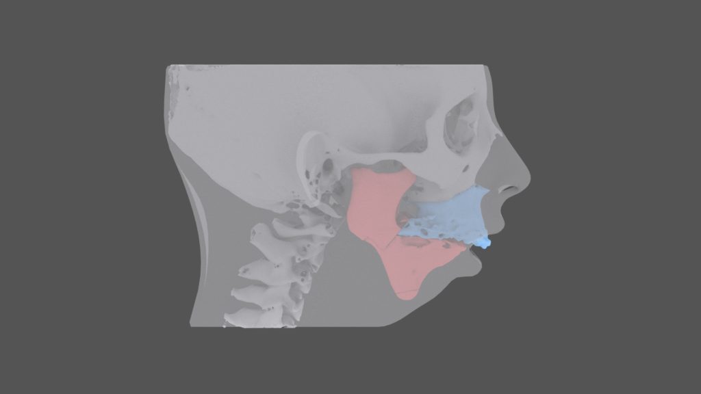 Surgical Planning for Dentistry: Digital Manipulation of the Jaw ⋆ X ...